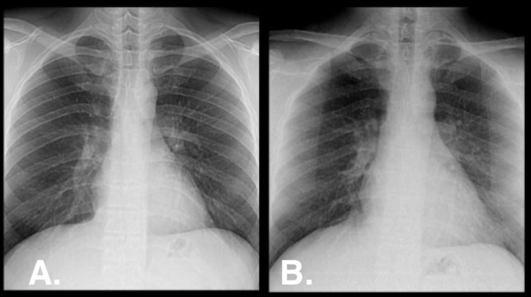 Chest X-Ray Basics: PA vs. AP - radRounds Radiology Network