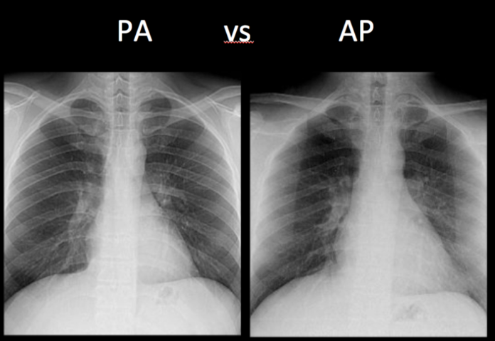 Chest X-Ray Basics: PA vs. AP - radRounds Radiology Network