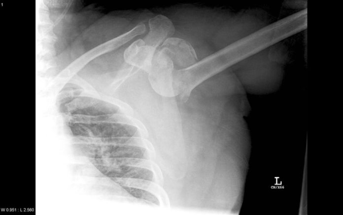 Luxatio Erecta (X-Ray) - radRounds Radiology Network