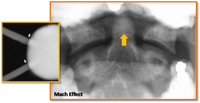Mach Effect - radRounds Radiology Network