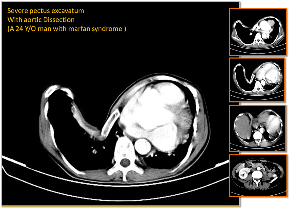 Severe pectus excavatum & aortic dissection - radRounds Radiology Network
