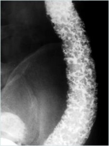 Pseudopolyps Ulcerative Colitis - radRounds Radiology Network