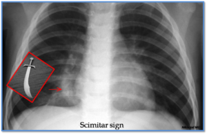 Scimitar sign - radRounds Radiology Network