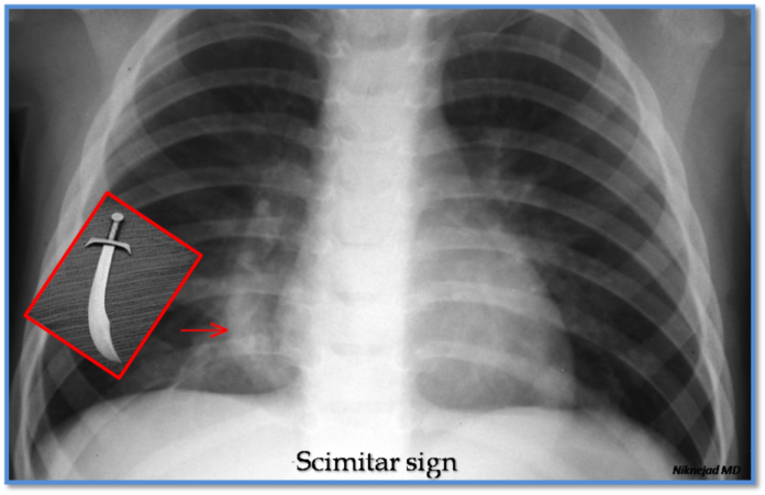 Scimitar sign - radRounds Radiology Network