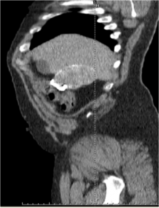 Retained Surgical Sponge - Gossypiboma - radRounds Radiology Network