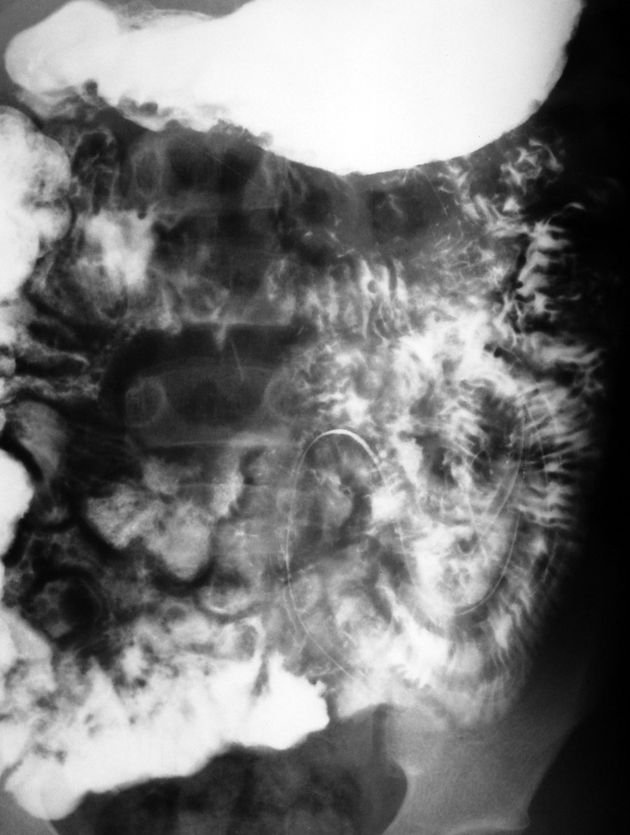Upper GI with Ascariasis (Parasitic Worms) - radRounds Radiology Network