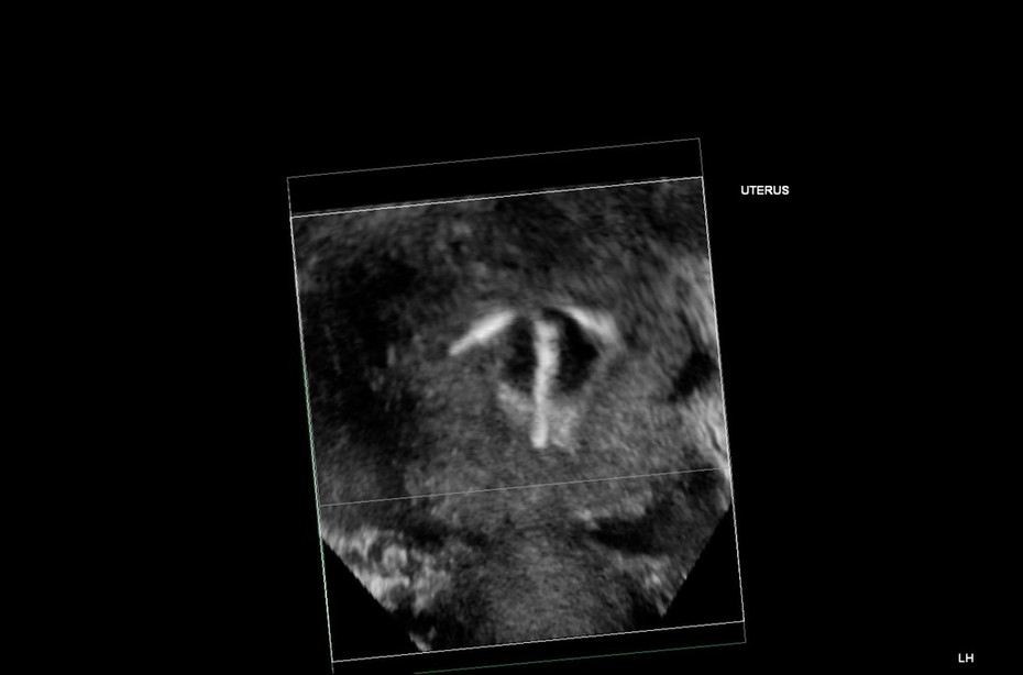 Intrauterine Device seen via 3D Reconstruction on Ultrasound ...