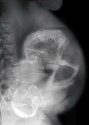 KUB - Case of the day - what is your diagnosis? - radRounds Radiology ...