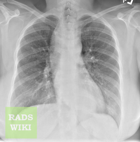 Radiograph - Achalasia - radRounds Radiology Network