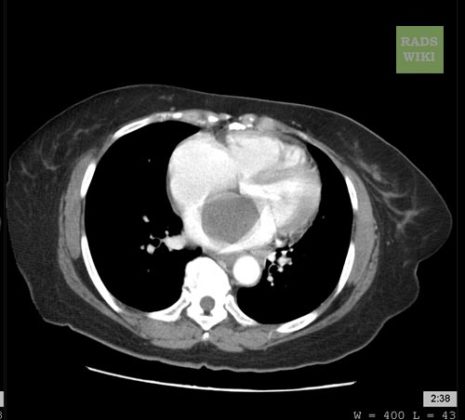 Atrial Myxoma CT Cardiac - radRounds Radiology Network