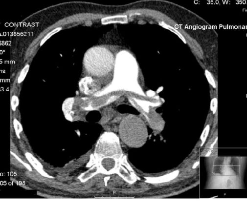 Saddle Pulmonary Embolism - CTA Chest - radRounds Radiology Network