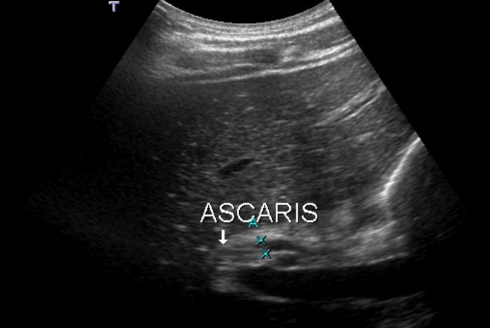 Ascaris in common bile duct - radRounds Radiology Network