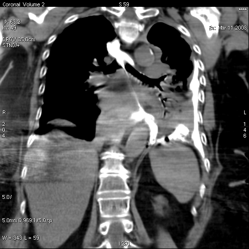 Ruptured Esophagus - radRounds Radiology Network