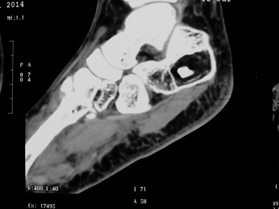 Interosseous Lipoma - radRounds Radiology Network