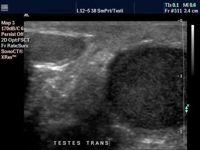 Testicular Leukemia (Ultrasound) - radRounds Radiology Network