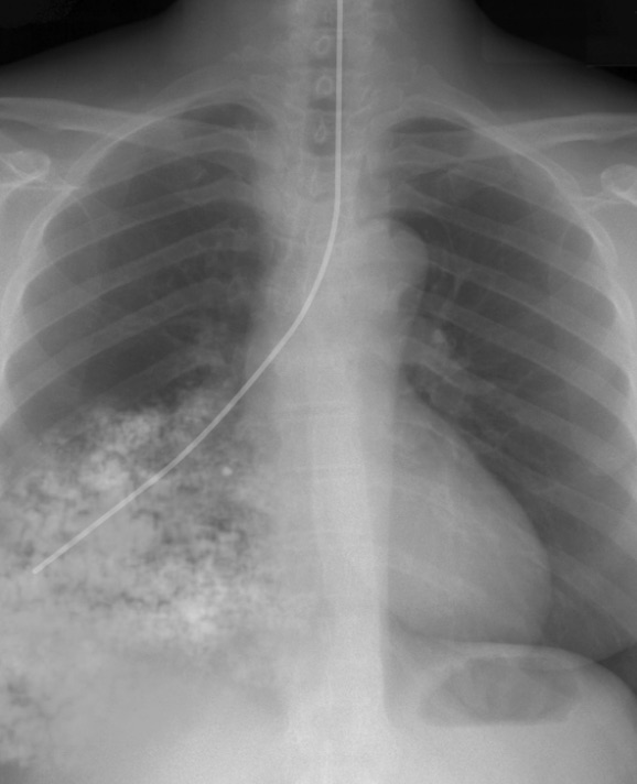 Misplaced feeding tube on chest x-ray - radRounds Radiology Network
