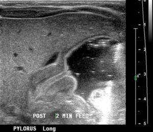 Pyloric Stenosis - radRounds Radiology Network