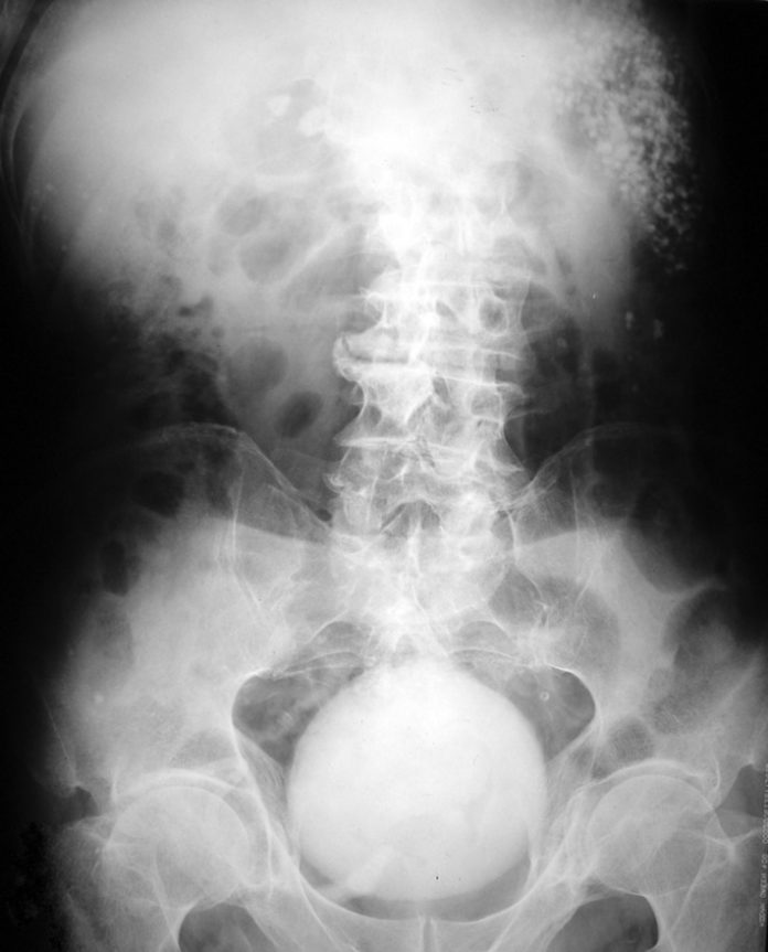 Splenic Phleboliths- Kidney Stone - radRounds Radiology Network