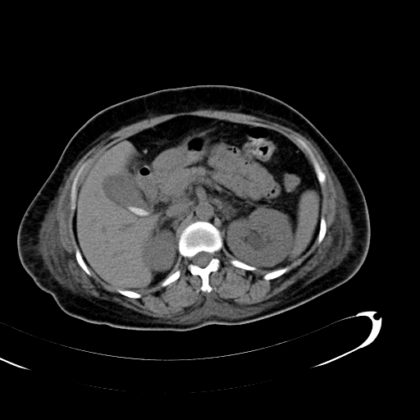 Milk of Calcium - radRounds Radiology Network