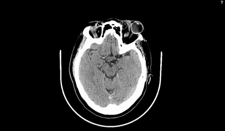 Orbital Dermoid - CT - radRounds Radiology Network