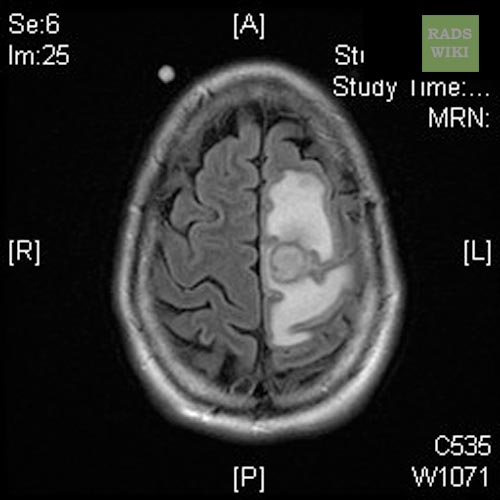 Abscess - MRI Brain - radRounds Radiology Network