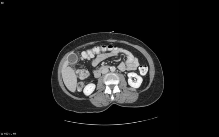Cholecystitis on CT - radRounds Radiology Network