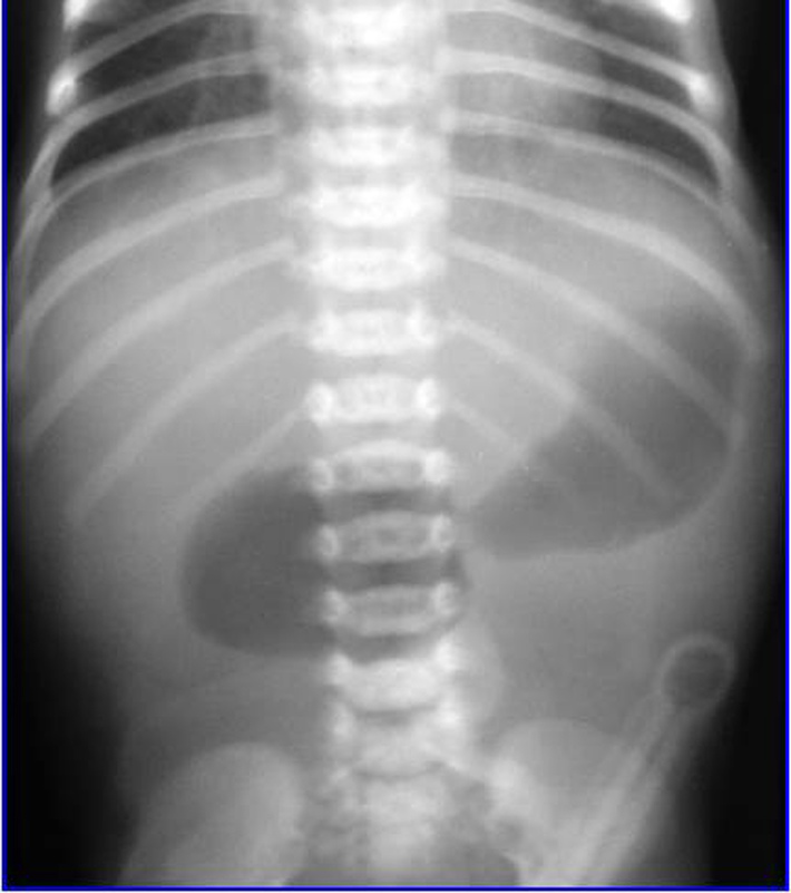 Duodenal Atresia Double Bubble Sign On X Ray Radrounds Radiology
