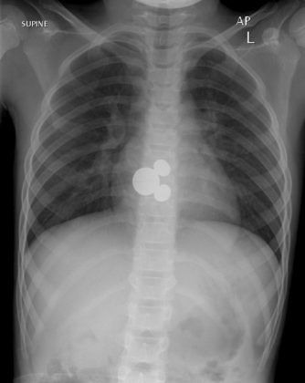 Foreign Body - Magnets - Pediatric CXR - radRounds Radiology Network