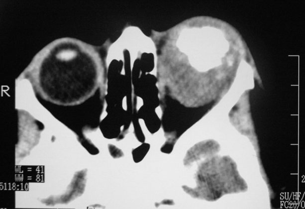 Retinoblastoma (CT) - radRounds Radiology Network