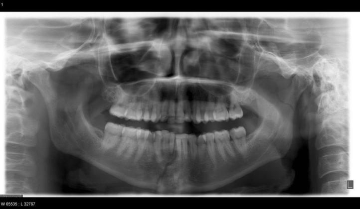 Mandible Fracture - radRounds Radiology Network