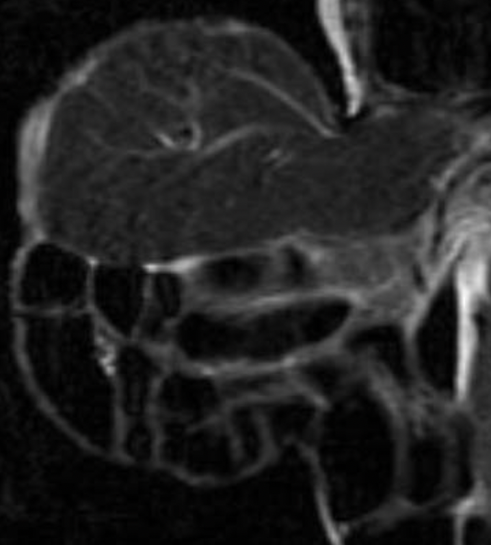 Omphalocoele - radRounds Radiology Network
