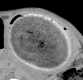 Trichobezoar - radRounds Radiology Network