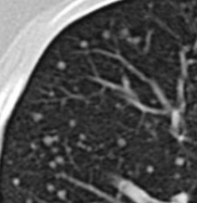 Miliary metastases - radRounds Radiology Network