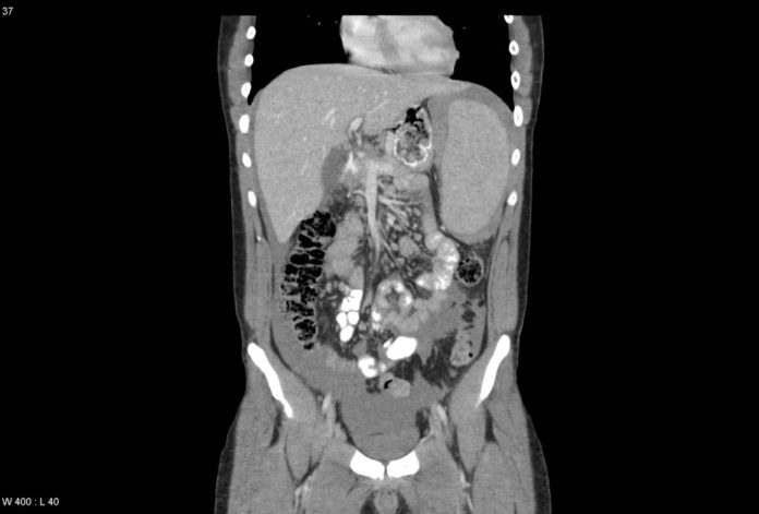 Splenic Rupture - CT Coronal - radRounds Radiology Network