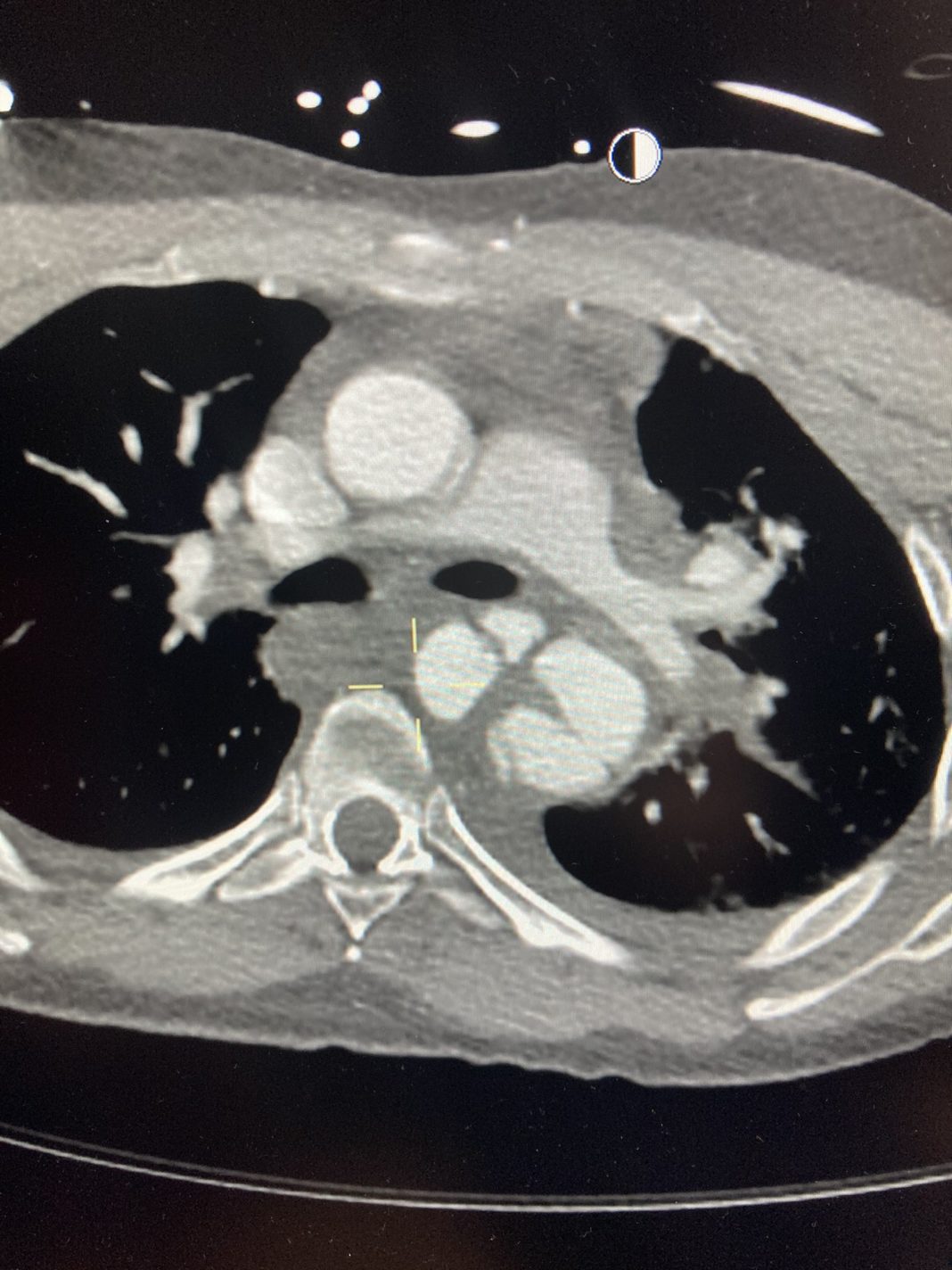 Traumatic Aortic Injury - radRounds Radiology Network