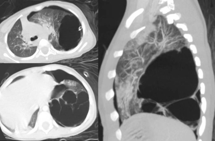 Congenital Cystic Adenomatoid Malformation (CCAM) - radRounds Radiology ...