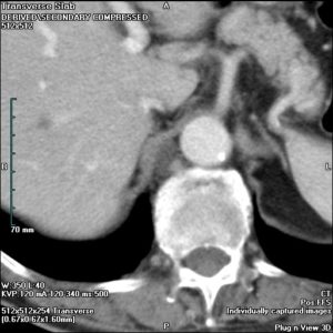 Cisterna Chyli - radRounds Radiology Network