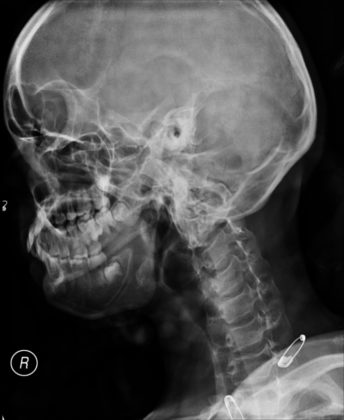 Sclerosis of the mastoid air cells - radRounds Radiology Network
