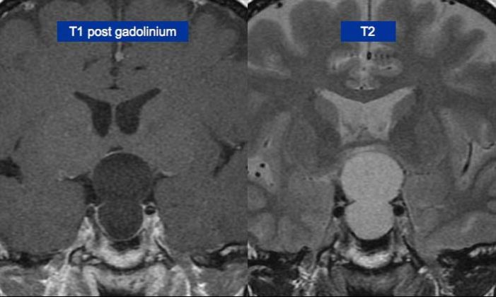 Rathke’s Cleft Cyst - radRounds Radiology Network