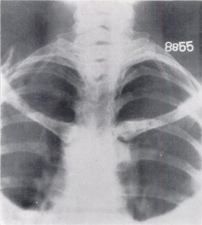Cervical Rib X-Ray - radRounds Radiology Network