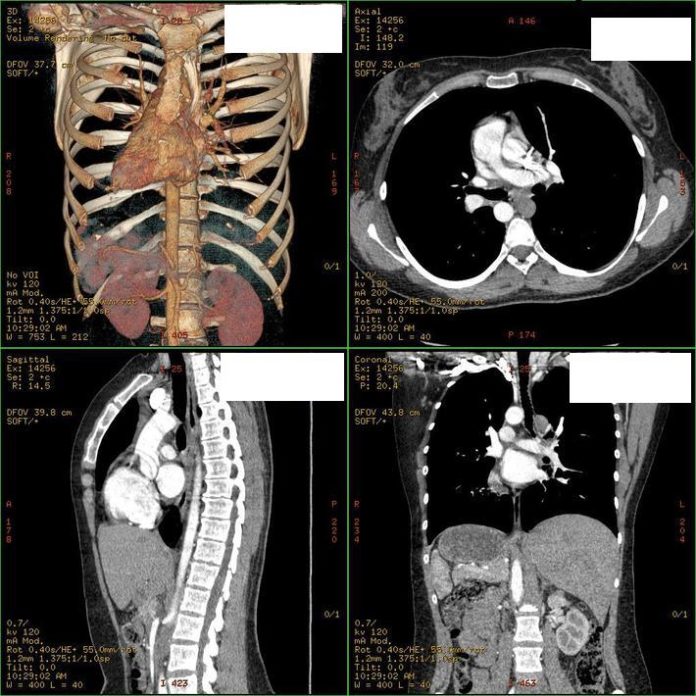 Situs Inversus (CT) - radRounds Radiology Network