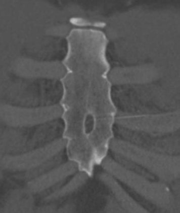 Sternal Foramen - radRounds Radiology Network