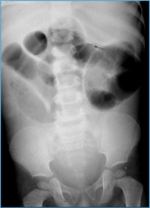 Small bowel volvulus - radRounds Radiology Network