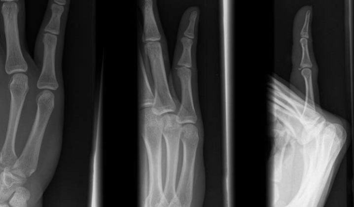 Volar Plate Fracture - radRounds Radiology Network